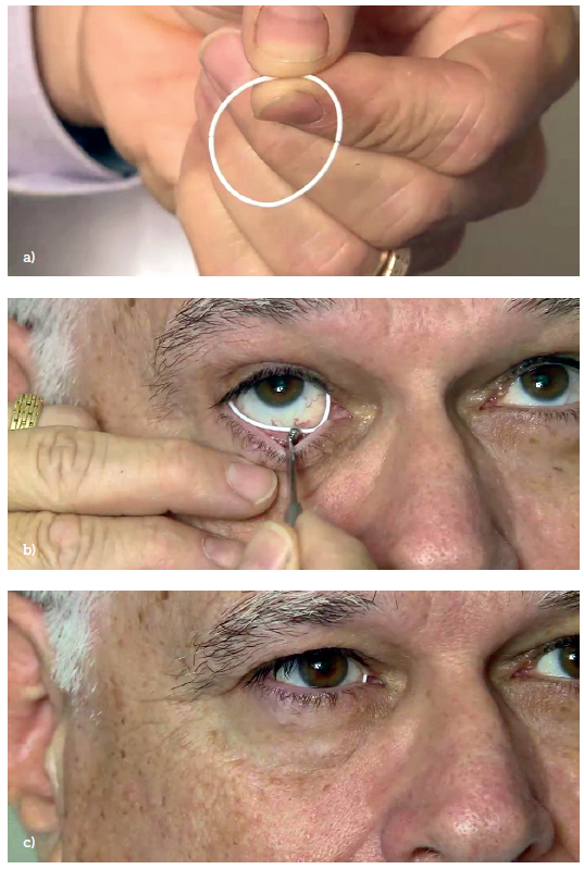 A TOPICAL OCULAR RING DESIGNED TO REPLACE GLAUCOMA EYE DROPS ...
