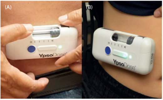 LARGE-VOLUME PATCH-INJECTION VIA YPSODOSE: SIMPLER FOR PHARMA COMPANIES ...
